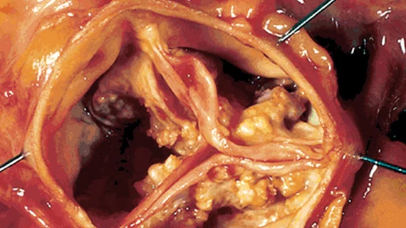 aortic stenosis operation