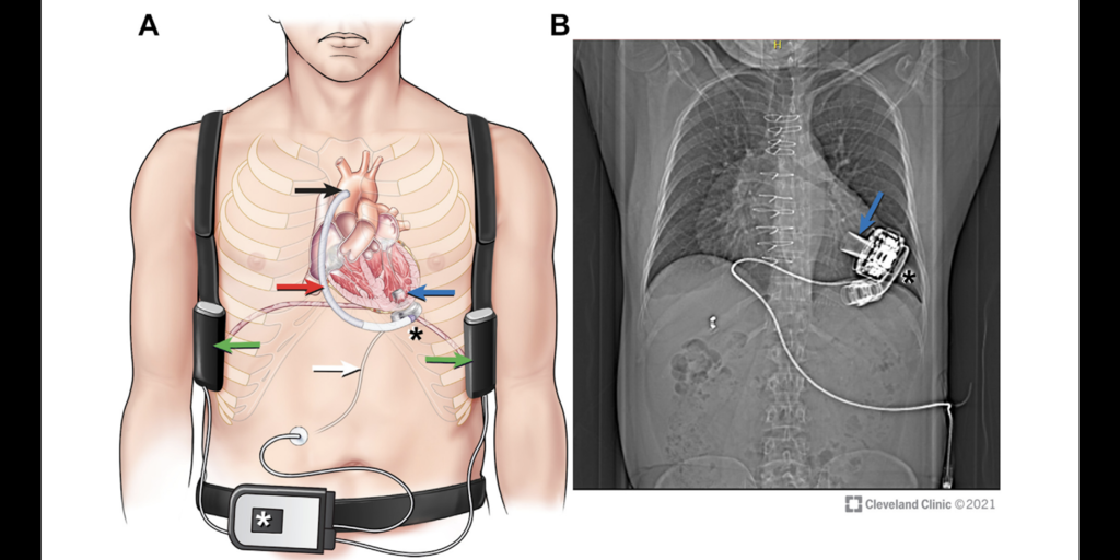 lvad device
